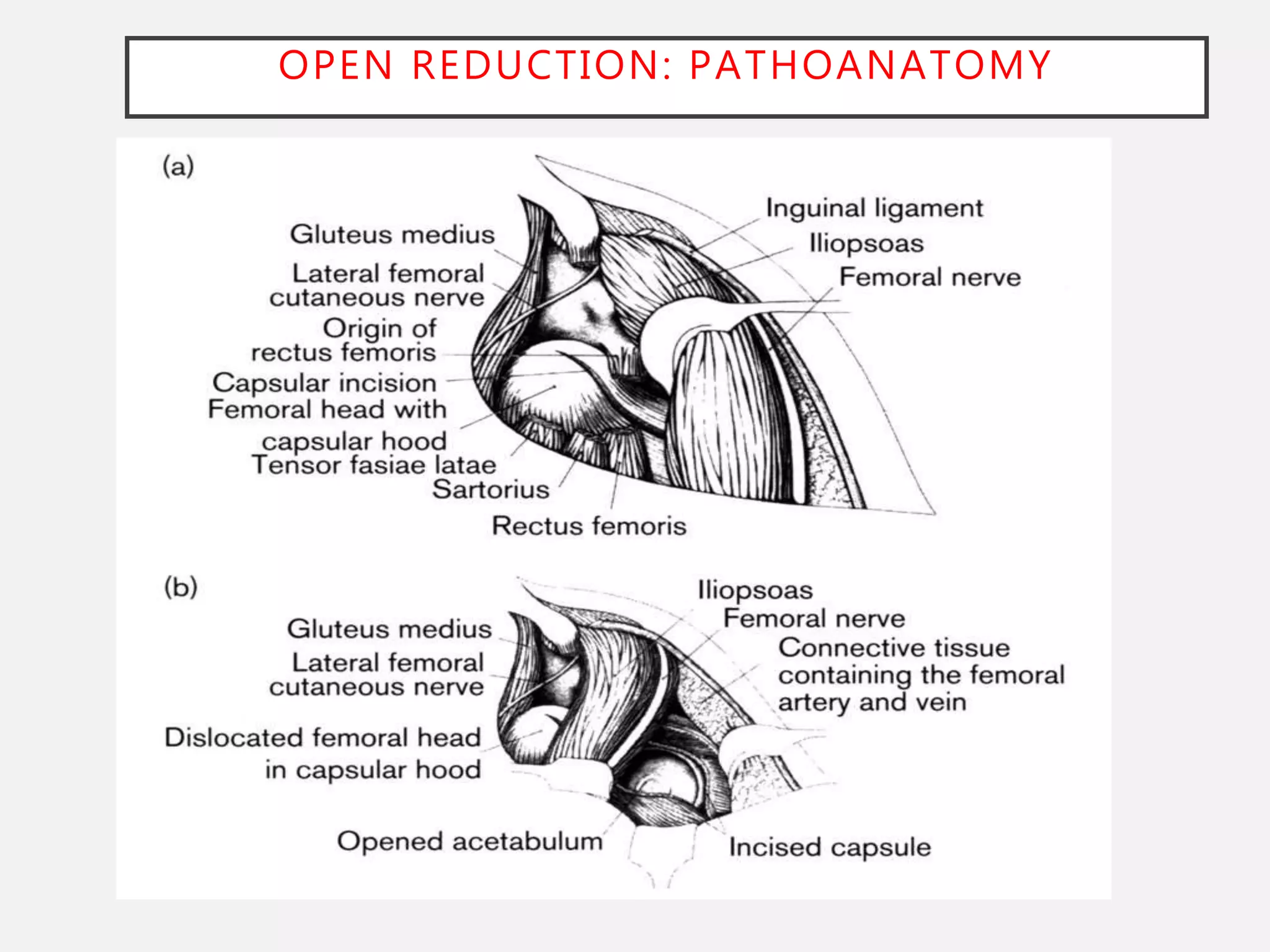 3a ddh open reduction principles & protocols | PPT