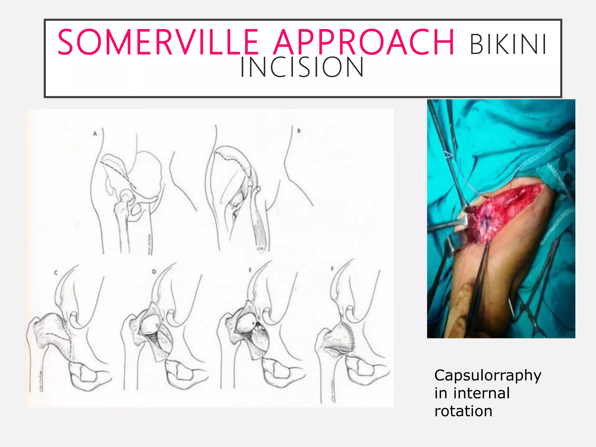3a ddh open reduction principles & protocols | PPT