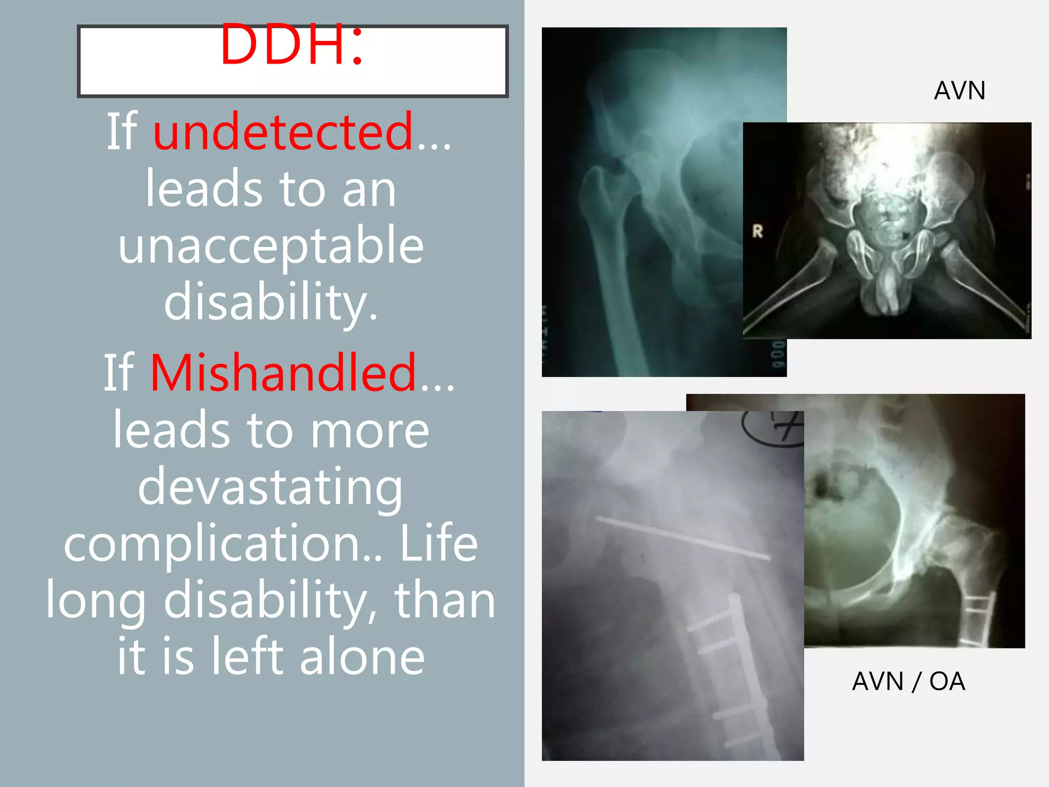 3a ddh open reduction principles & protocols | PPT