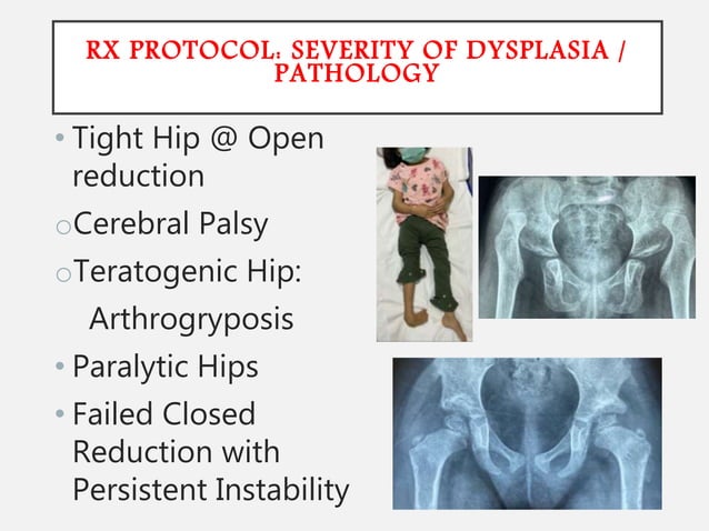 3a ddh open reduction principles & protocols | PPT