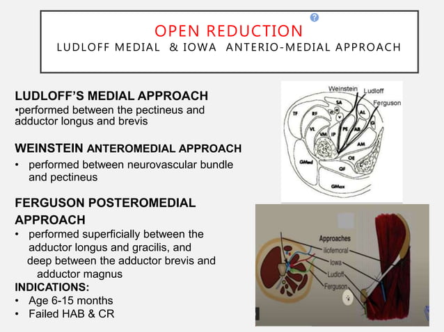 3a ddh open reduction principles & protocols | PPT