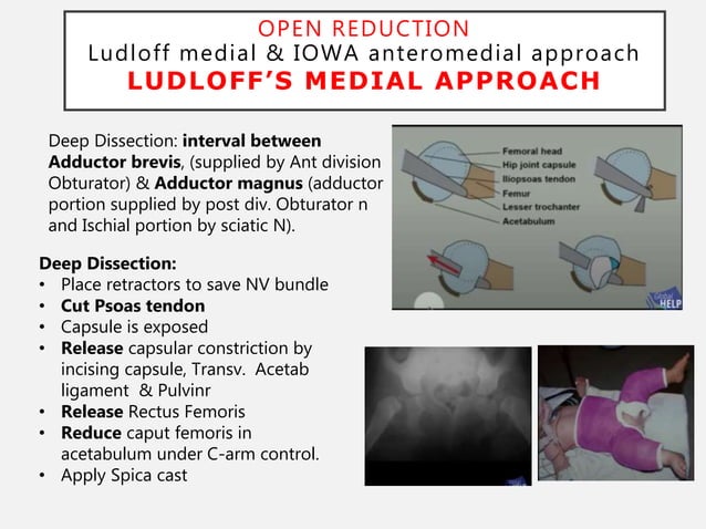 3a ddh open reduction principles & protocols | PPT