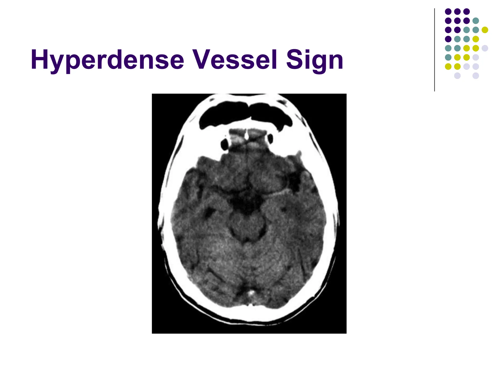 3_AlApproach to CVA in the Emergency Department | PDF