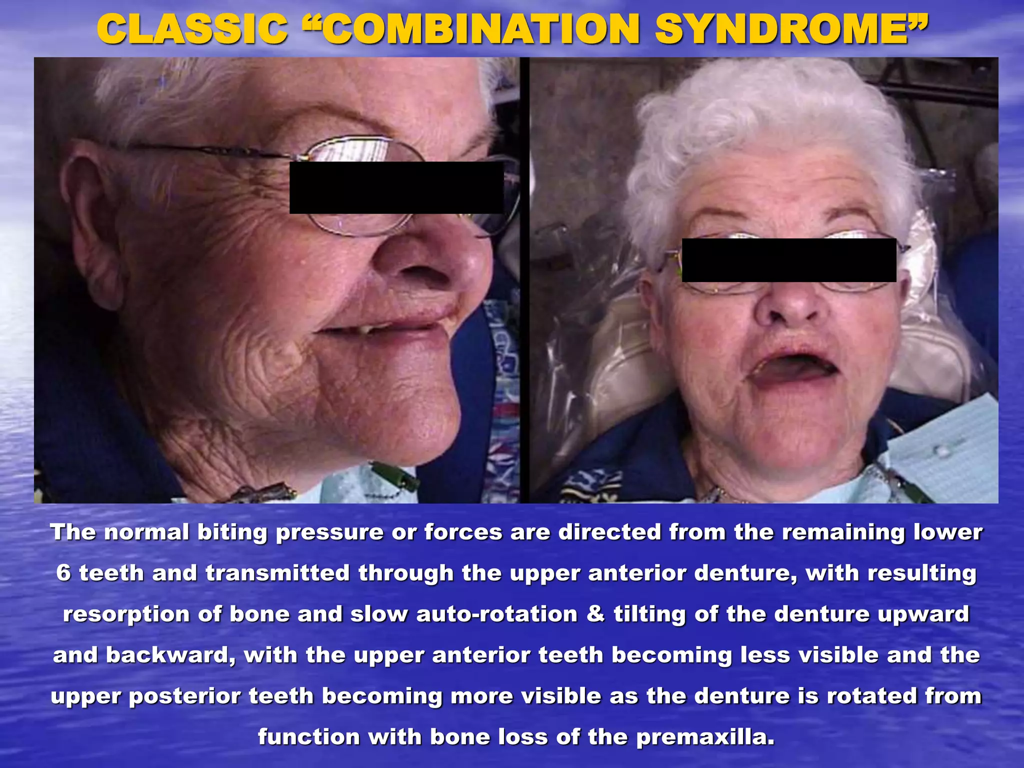 3 b combination syndrome | PPT