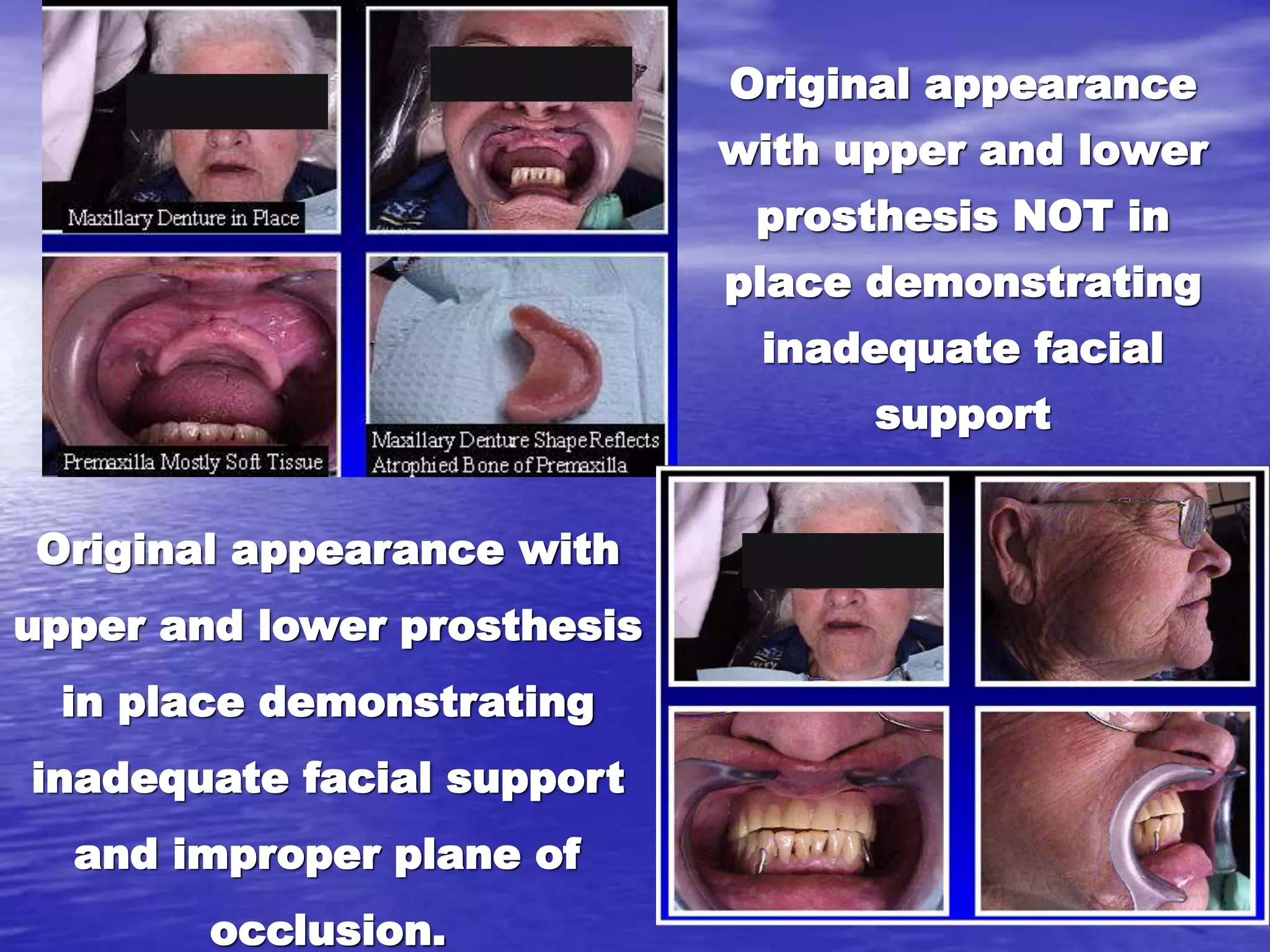 3 b combination syndrome | PPT
