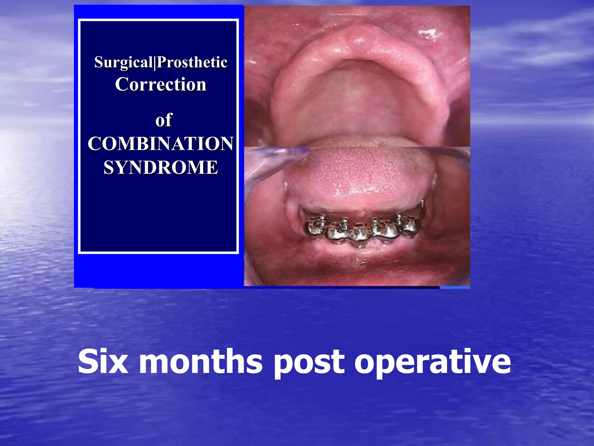 3 b combination syndrome | PPT