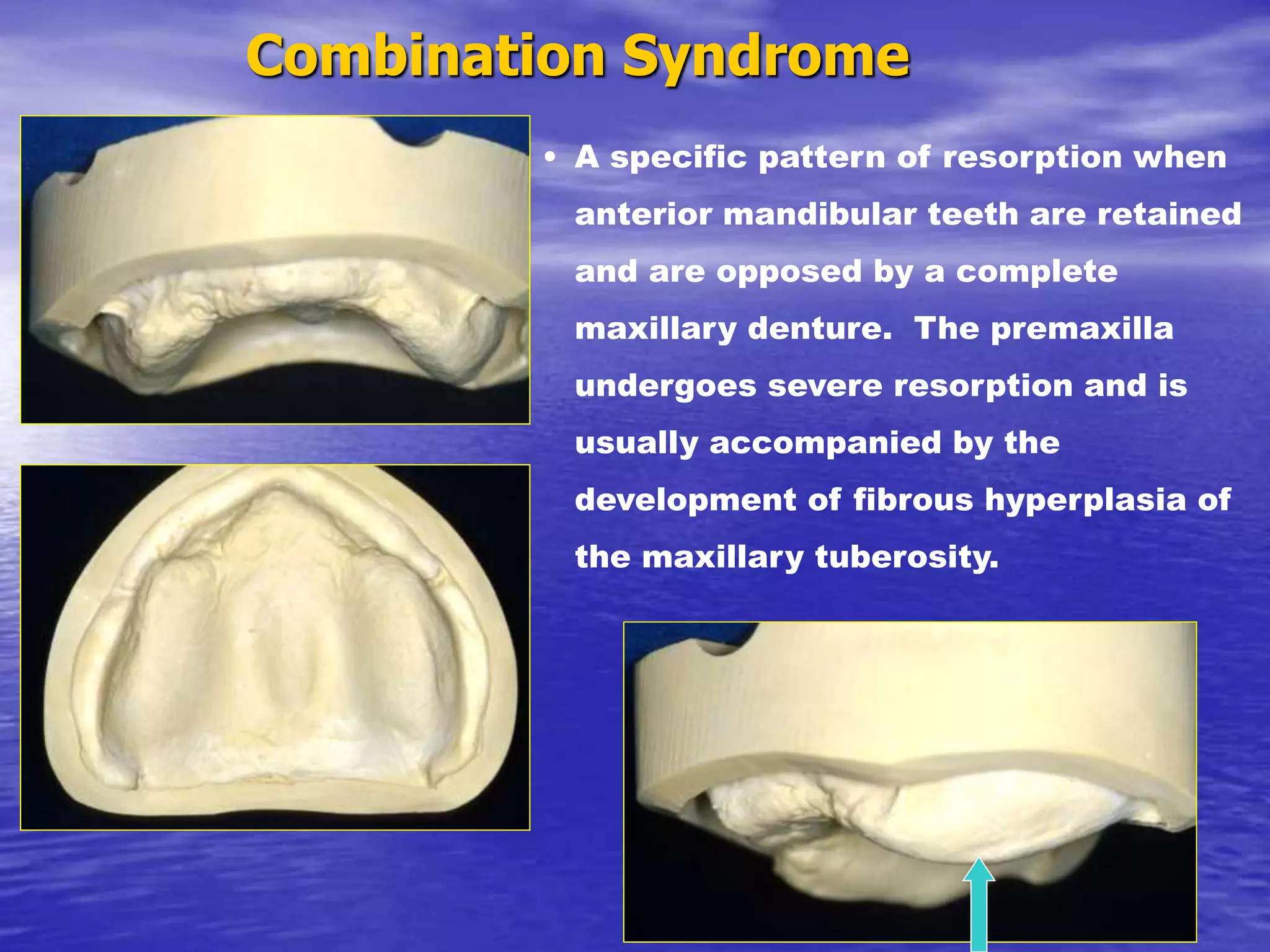 3 b combination syndrome | PPT