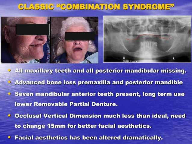3 b combination syndrome | PPT | Dental Health | Diseases and Conditions