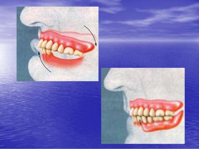 3 b combination syndrome