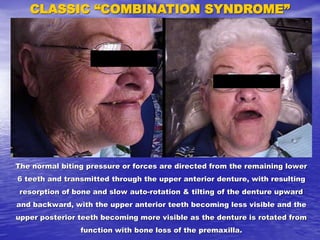 3 b combination syndrome | PPT