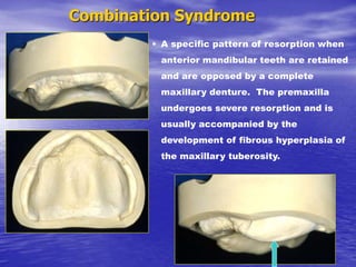 3 b combination syndrome | PPT