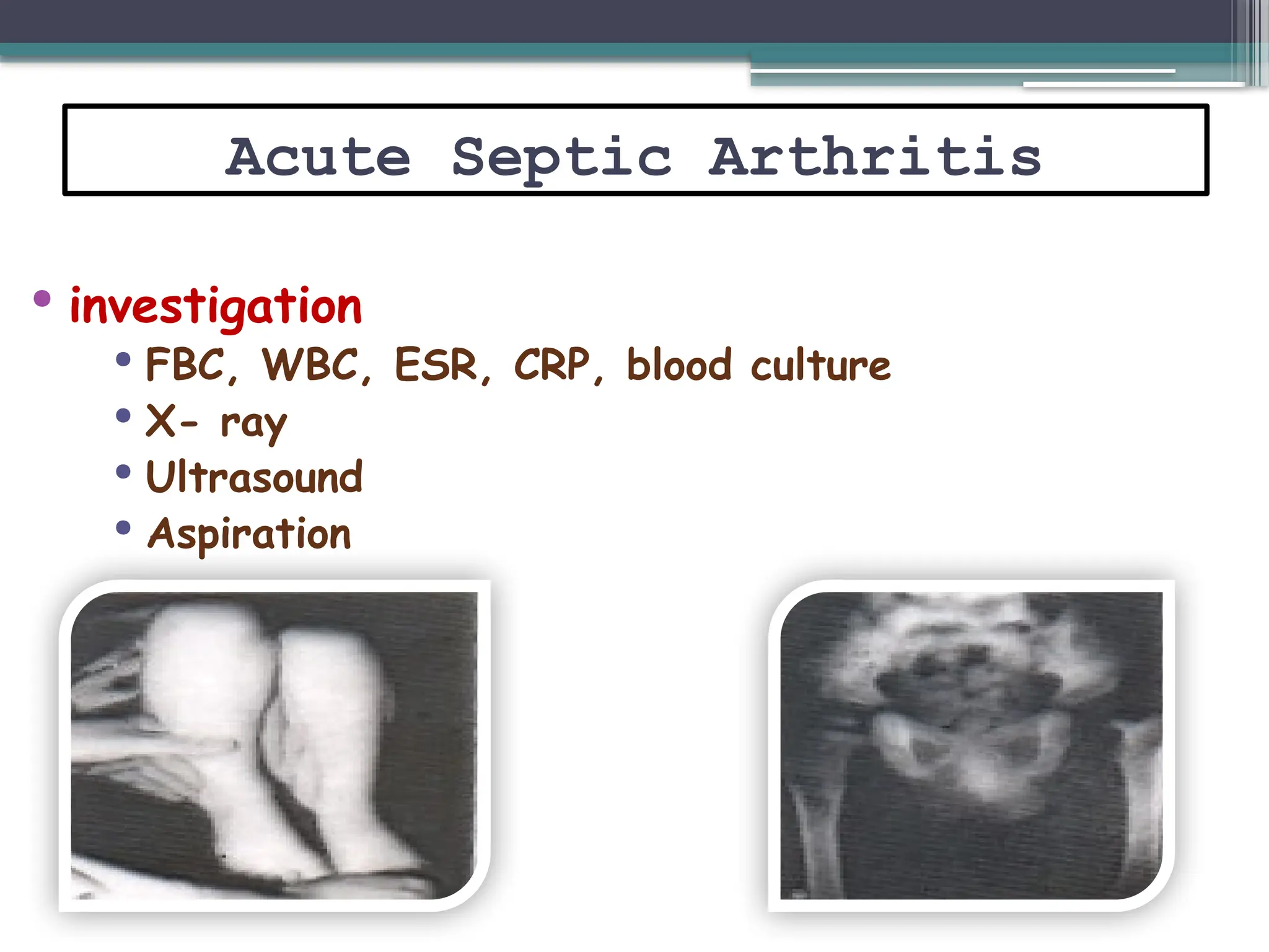 3_Bone and joints infection lecture2022.pptx