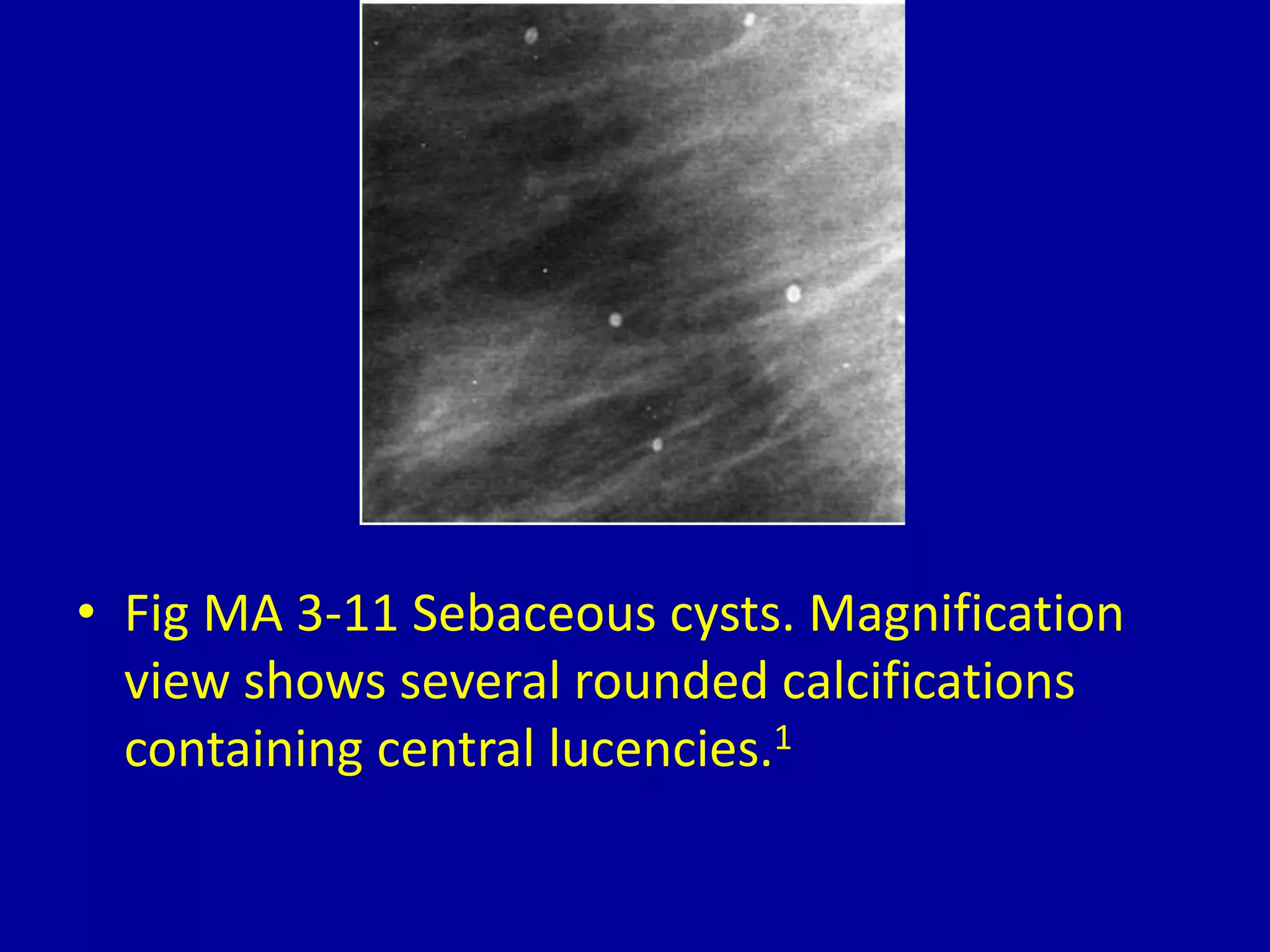 3 breast calcifications | PPTX