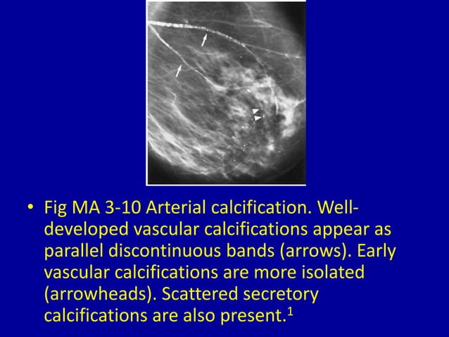 3 breast calcifications | PPTX