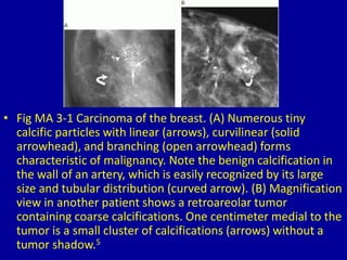 Linear Calcifications Mammogram – EMXVRB