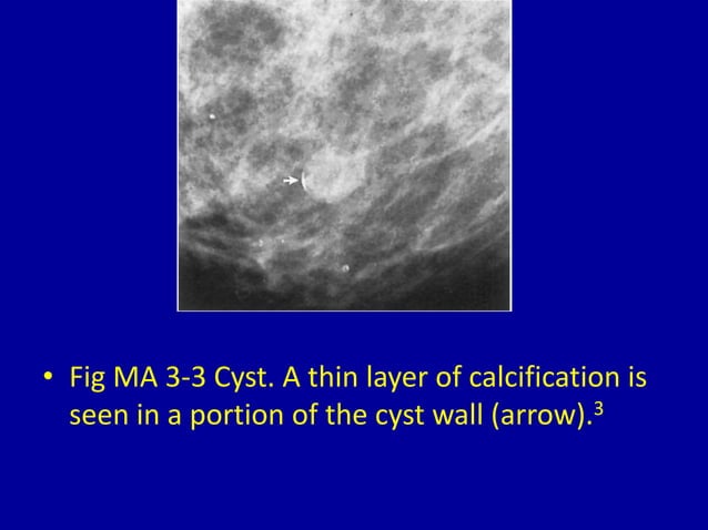 3 breast calcifications | PPTX