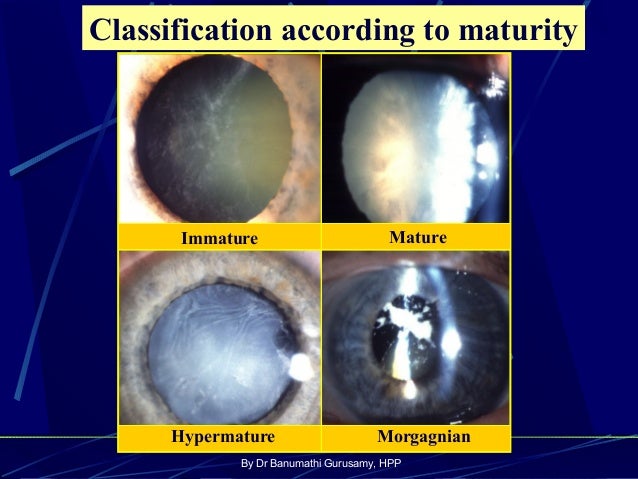 Immature Cataract