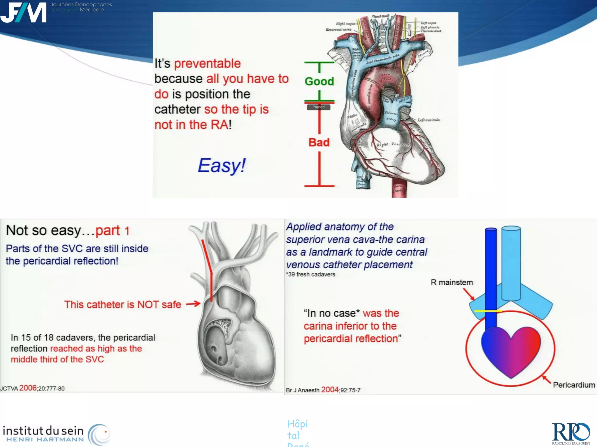 Catheter tip positioning control in chest port implantation. Luc ...