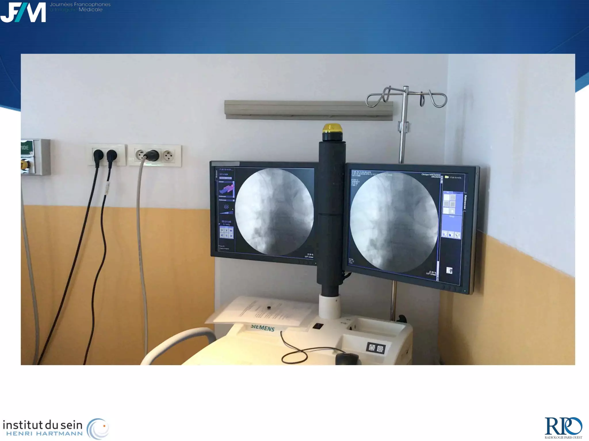 Catheter tip positioning control in chest port implantation. Luc ...