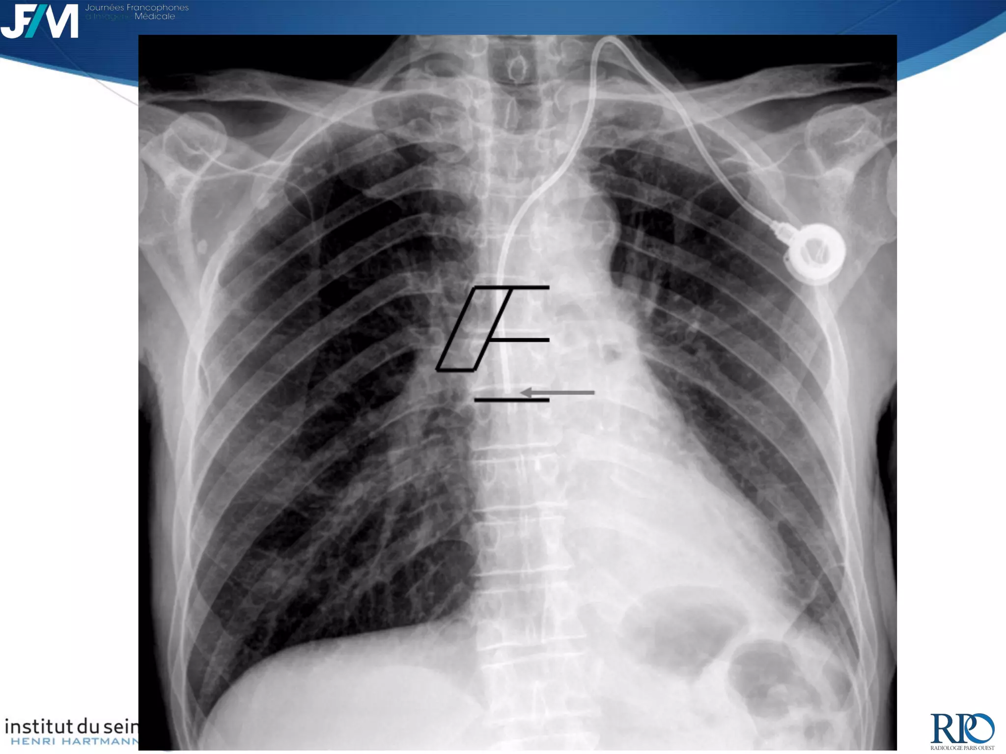 Catheter tip positioning control in chest port implantation. Luc ...