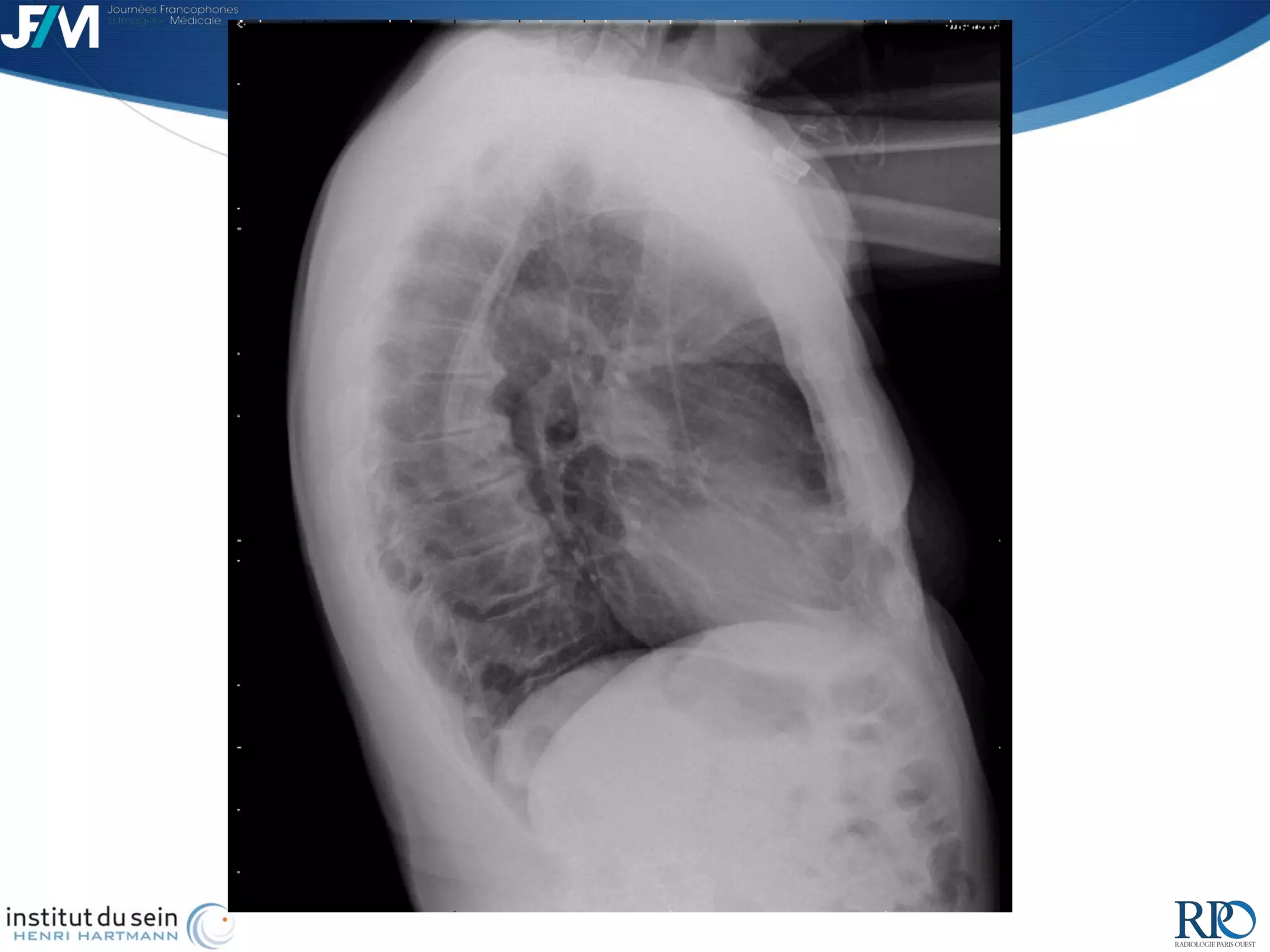 Catheter tip positioning control in chest port implantation. Luc ...