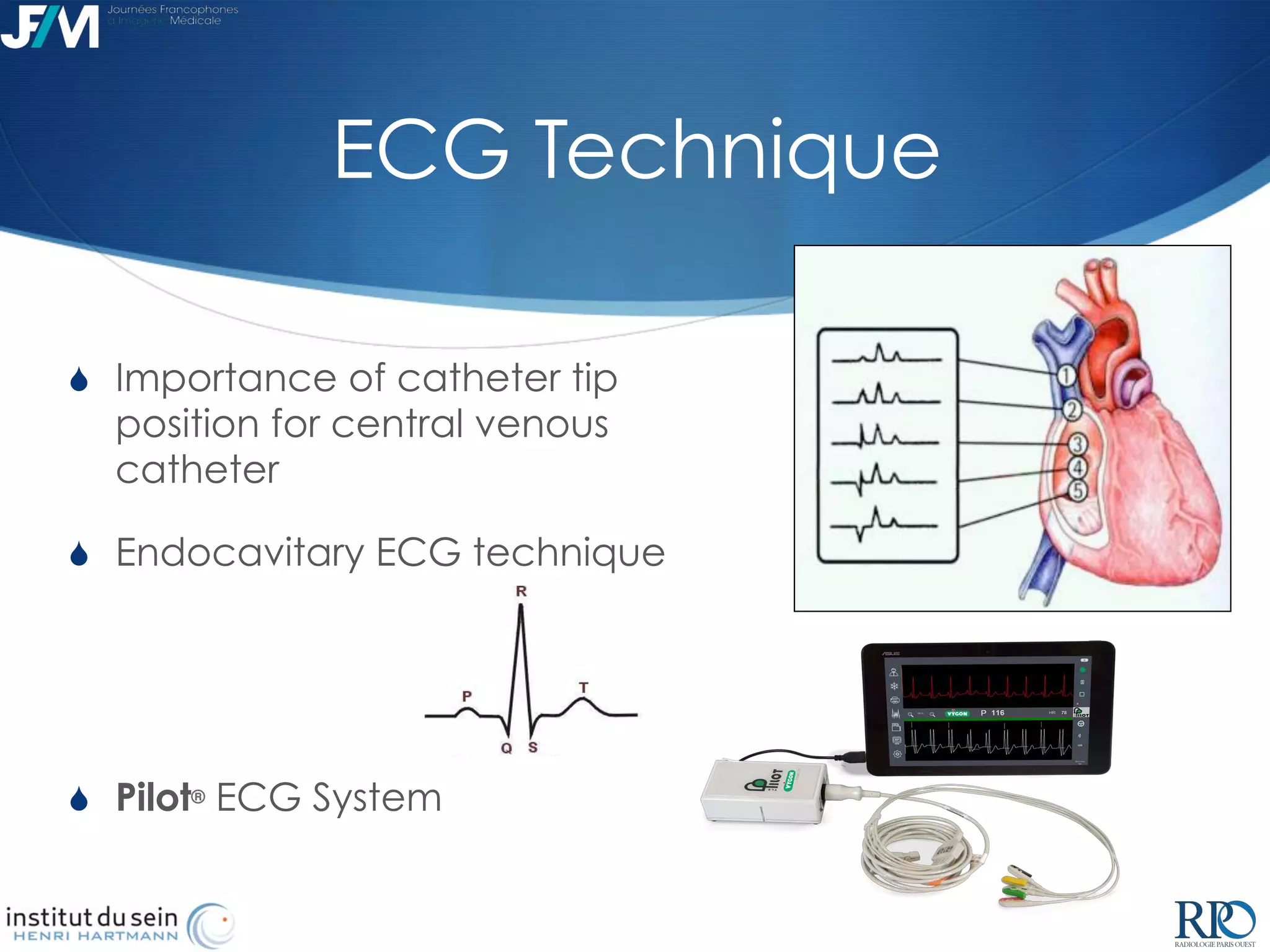 Catheter tip positioning control in chest port implantation. Luc ...