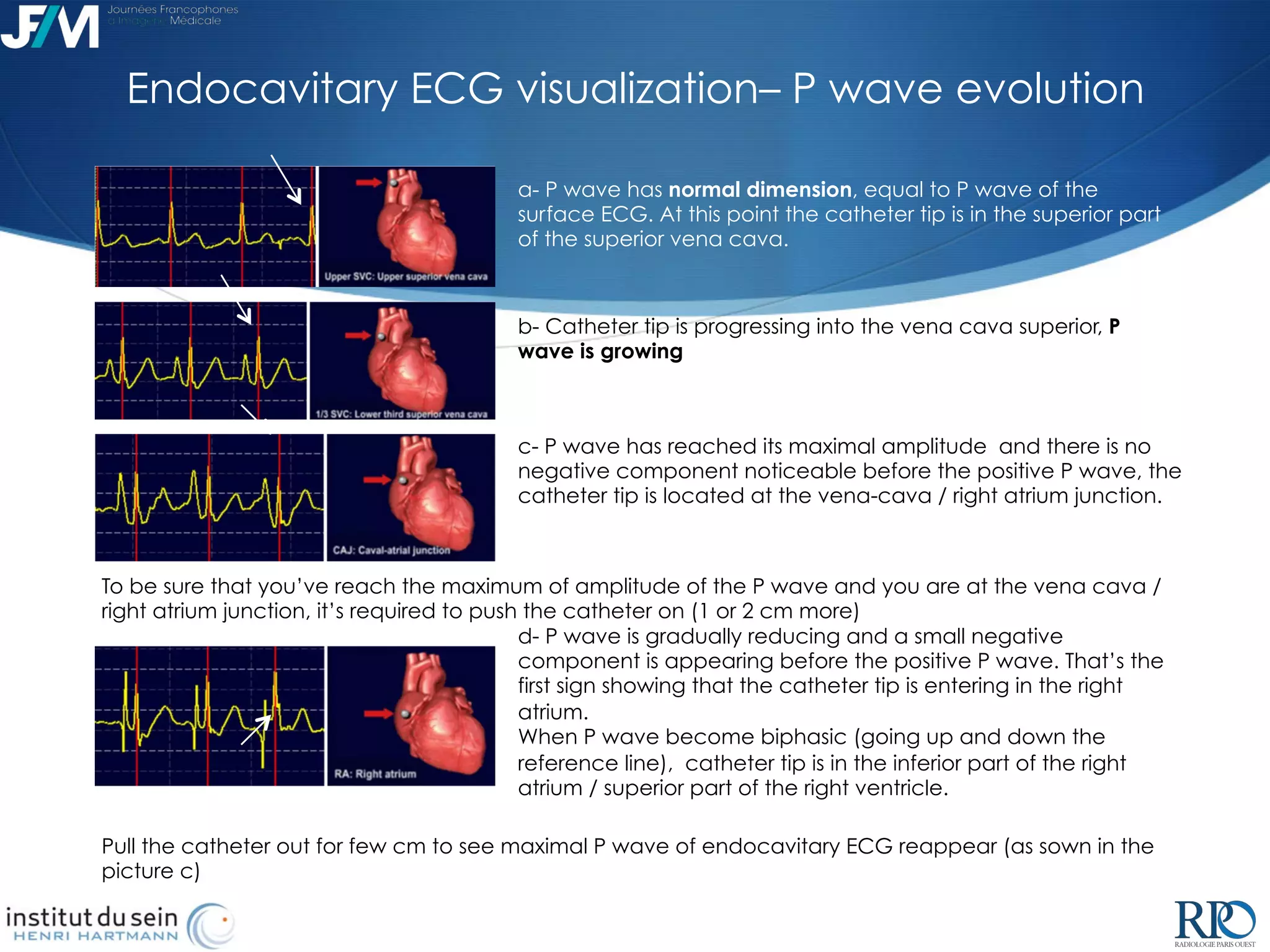 Catheter tip positioning control in chest port implantation. Luc ...