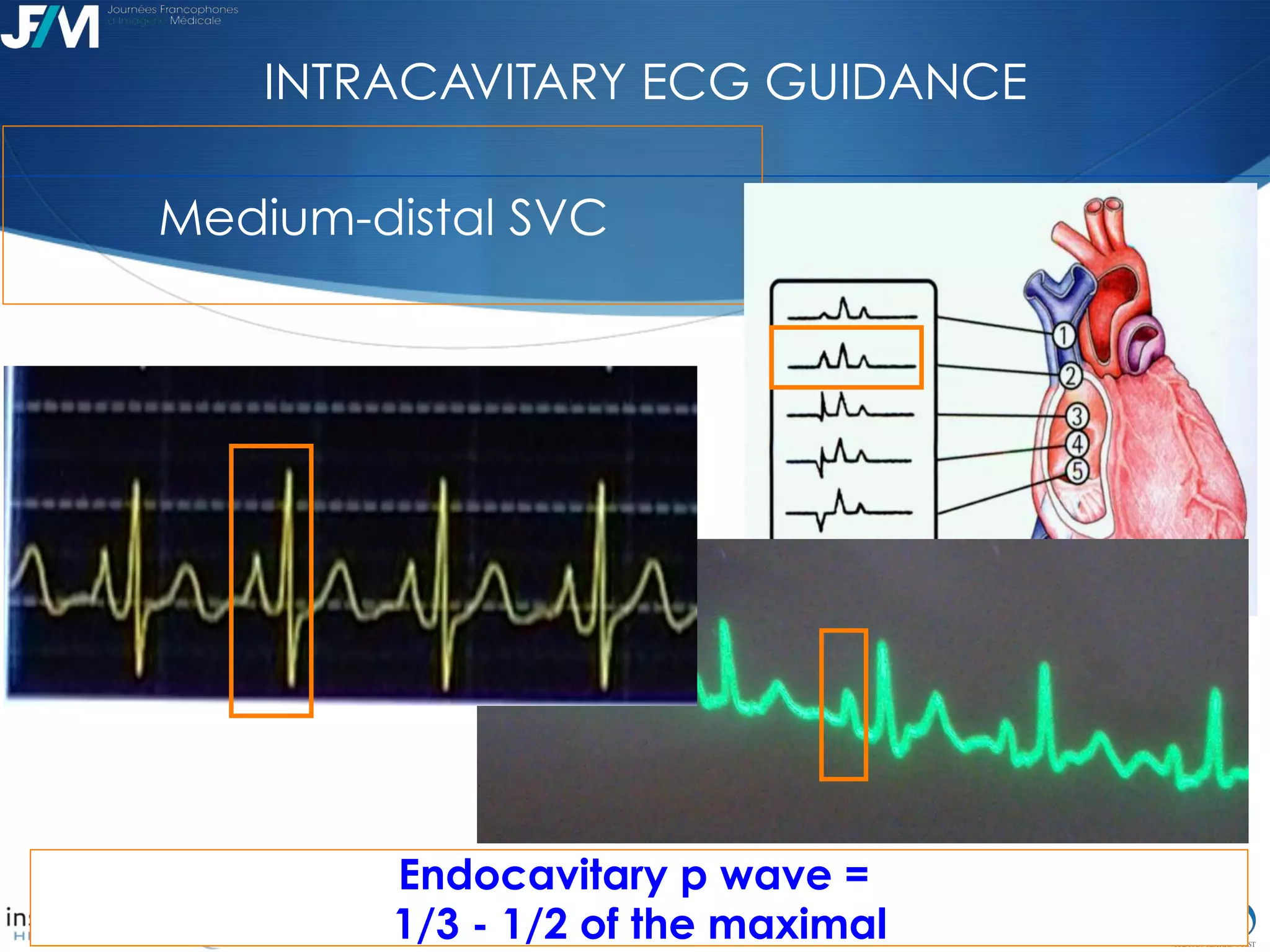 Catheter tip positioning control in chest port implantation. Luc ...