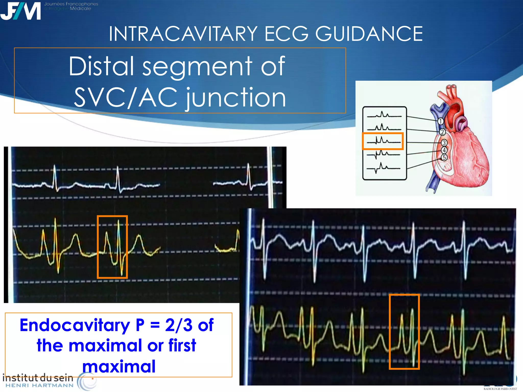 Catheter tip positioning control in chest port implantation. Luc ...