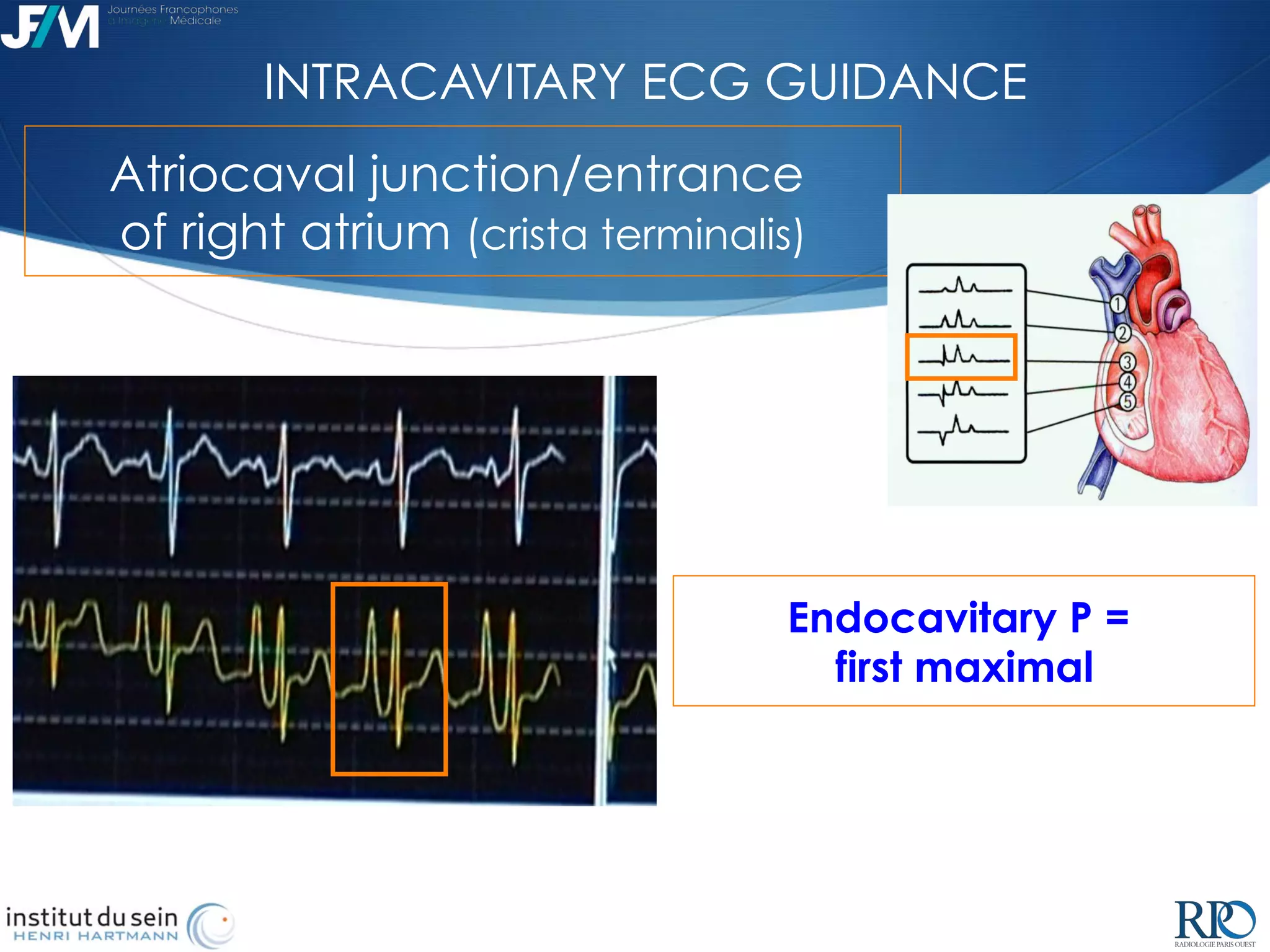 Catheter tip positioning control in chest port implantation. Luc ...