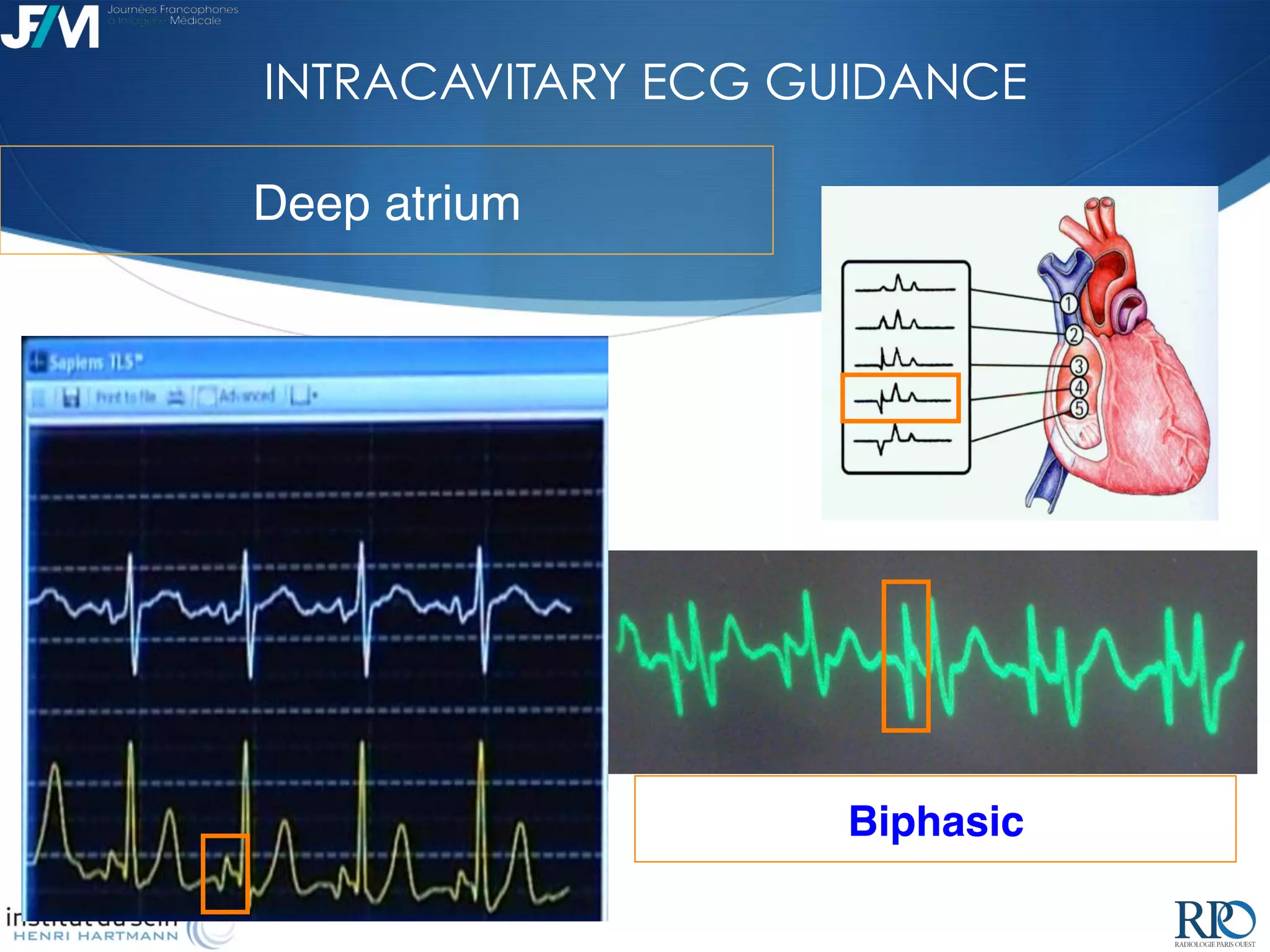 Catheter tip positioning control in chest port implantation. Luc ...