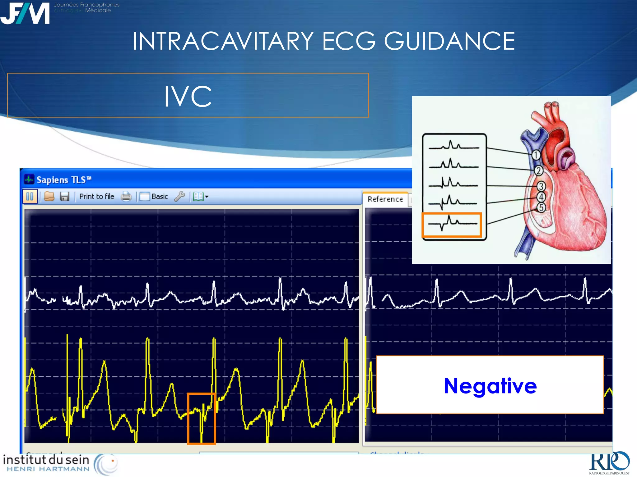 Catheter tip positioning control in chest port implantation. Luc ...