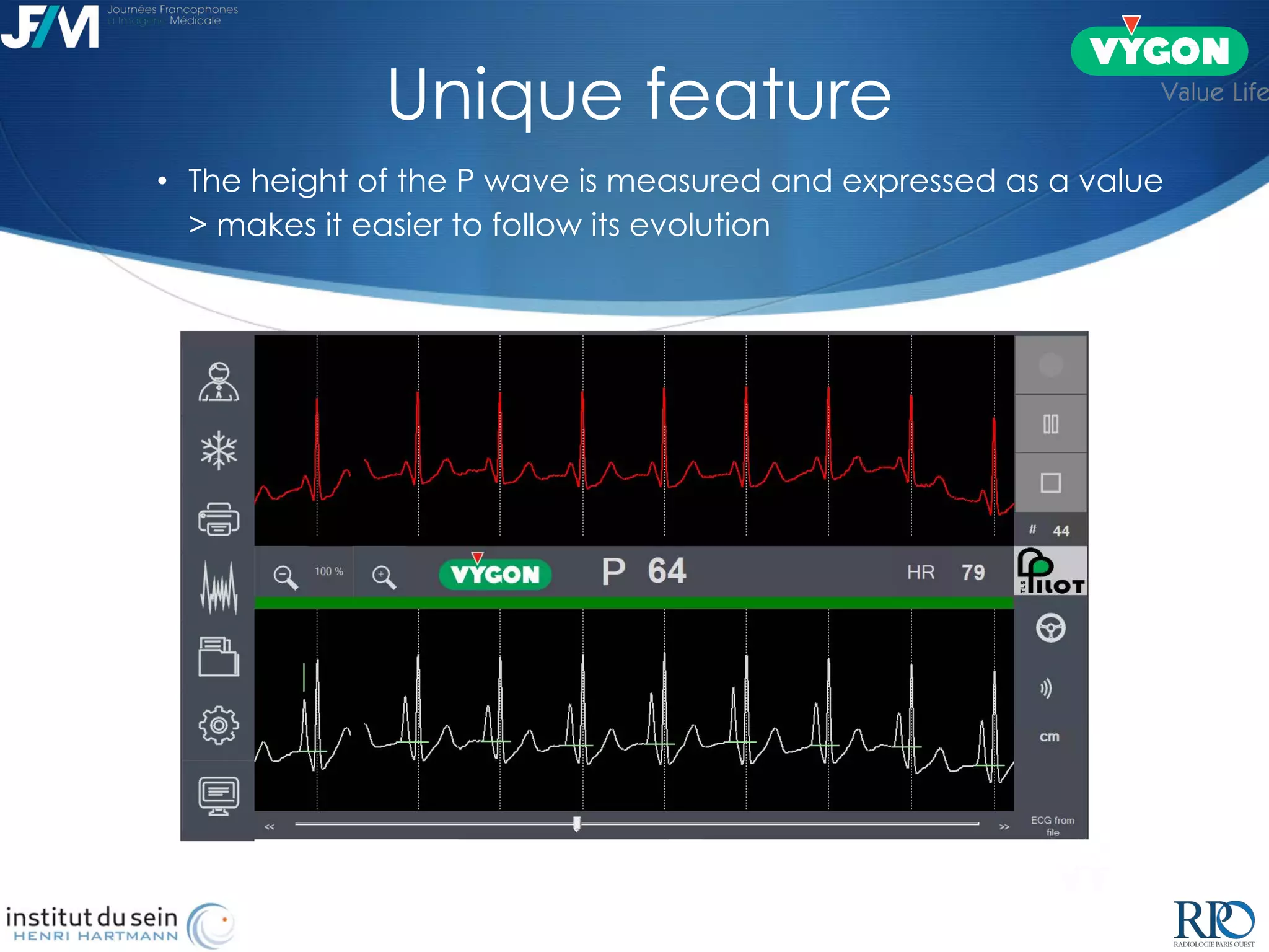 Catheter tip positioning control in chest port implantation. Luc ...