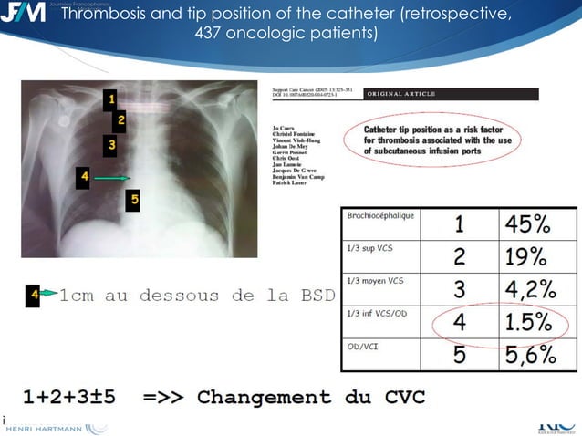 Catheter tip positioning control in chest port implantation. Luc ...