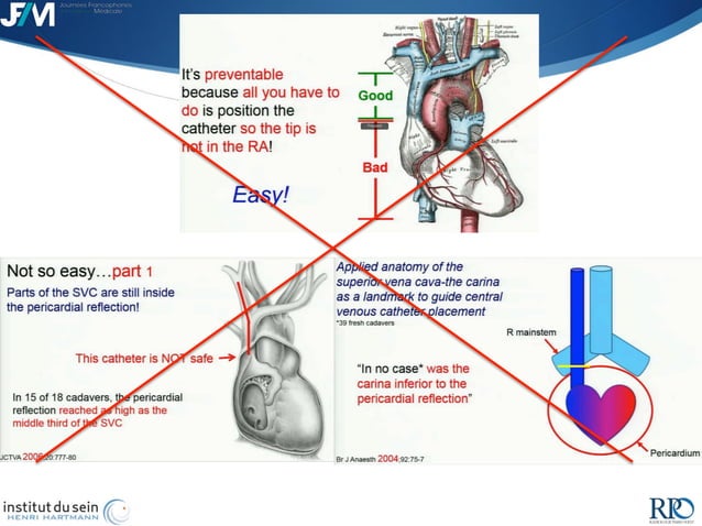 Catheter tip positioning control in chest port implantation. Luc ...