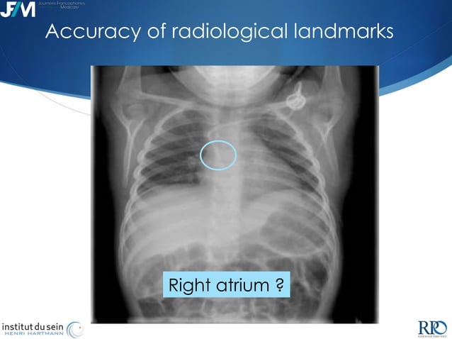 Catheter tip positioning control in chest port implantation. Luc ...