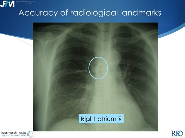 Catheter tip positioning control in chest port implantation. Luc ...
