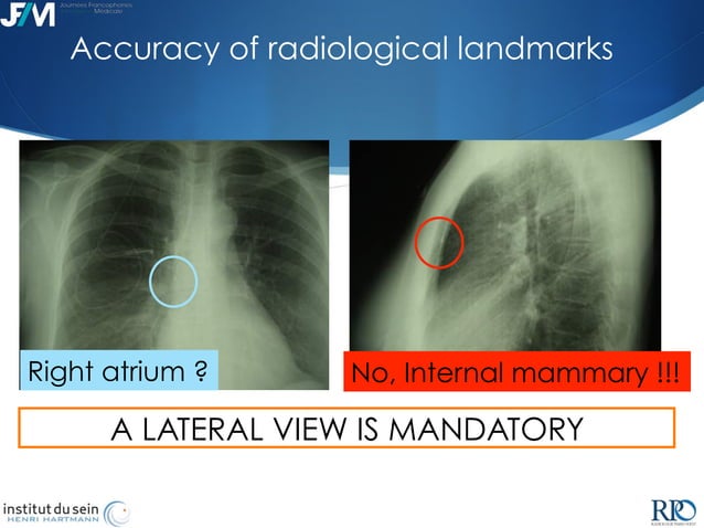 Catheter tip positioning control in chest port implantation. Luc ...