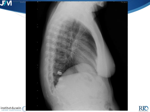 Catheter tip positioning control in chest port implantation. Luc ...