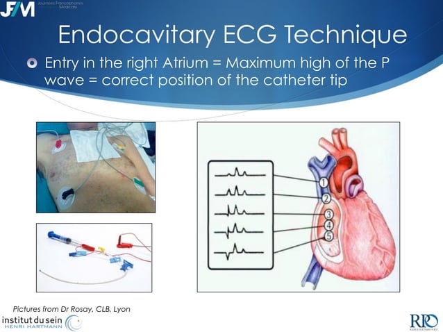 Catheter tip positioning control in chest port implantation. Luc ...