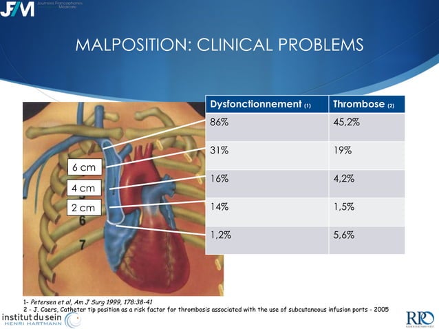 Catheter tip positioning control in chest port implantation. Luc ...