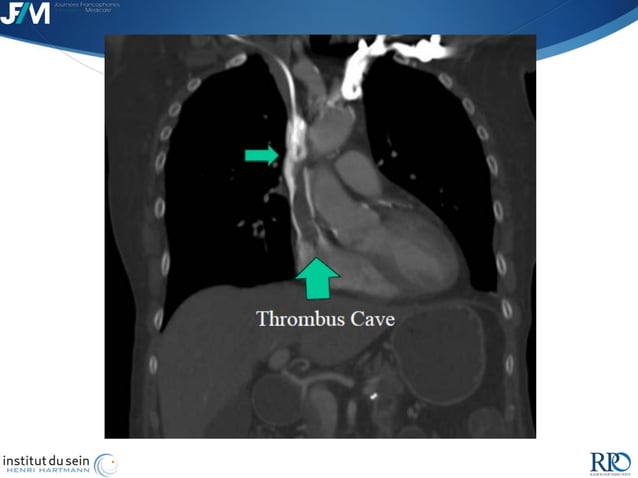 Catheter tip positioning control in chest port implantation. Luc ...