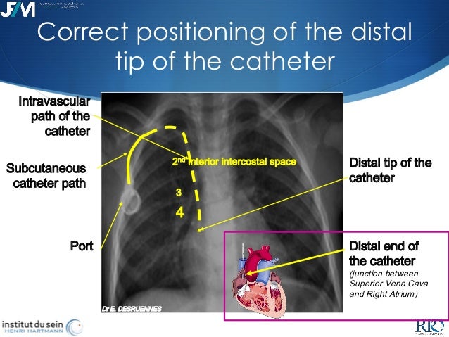 Catheter tip positioning control in chest port implantation. Luc Rote…