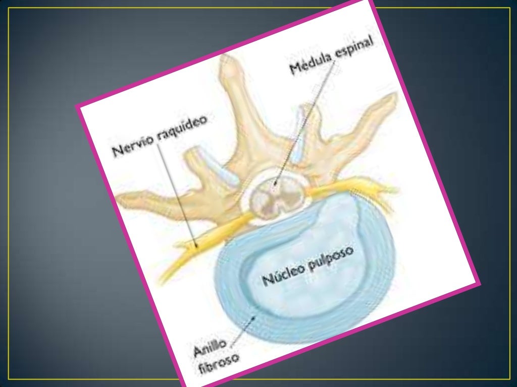 compresion radicular