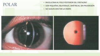 CRISTALINO Y SUS PATOLOGÍAS (TIPOS DE CATARATAS) | PDF
