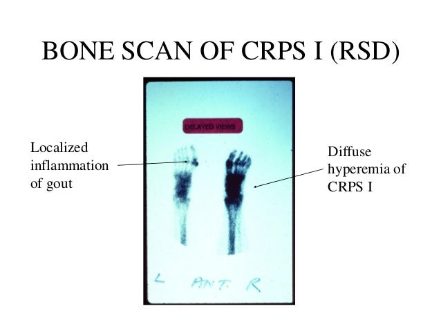 CRPS I (RSD) with pictures. Differential Diagnosis