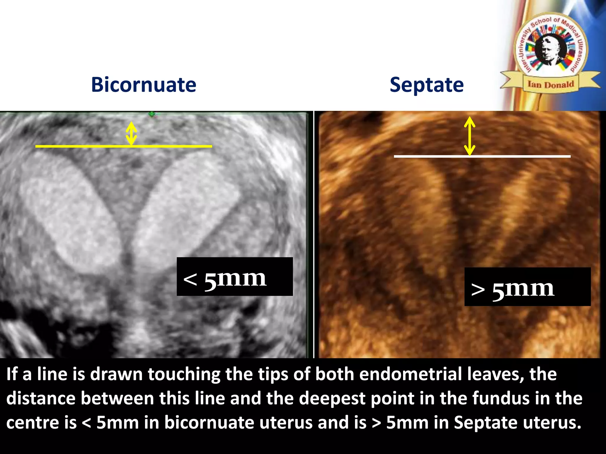 3D-4D ULTRASOUND IN UTERINE SEPTUM EVALUATION | PPTX