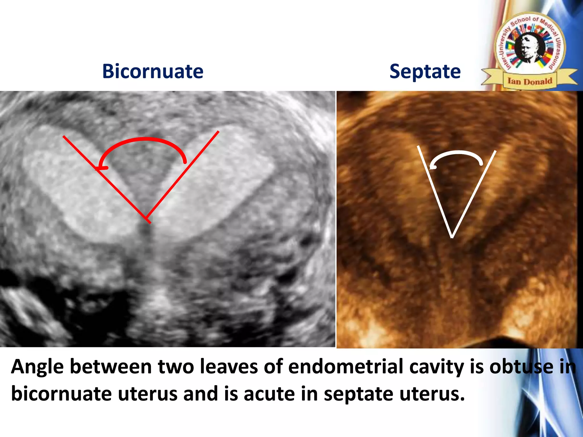 3D-4D ULTRASOUND IN UTERINE SEPTUM EVALUATION | PPTX