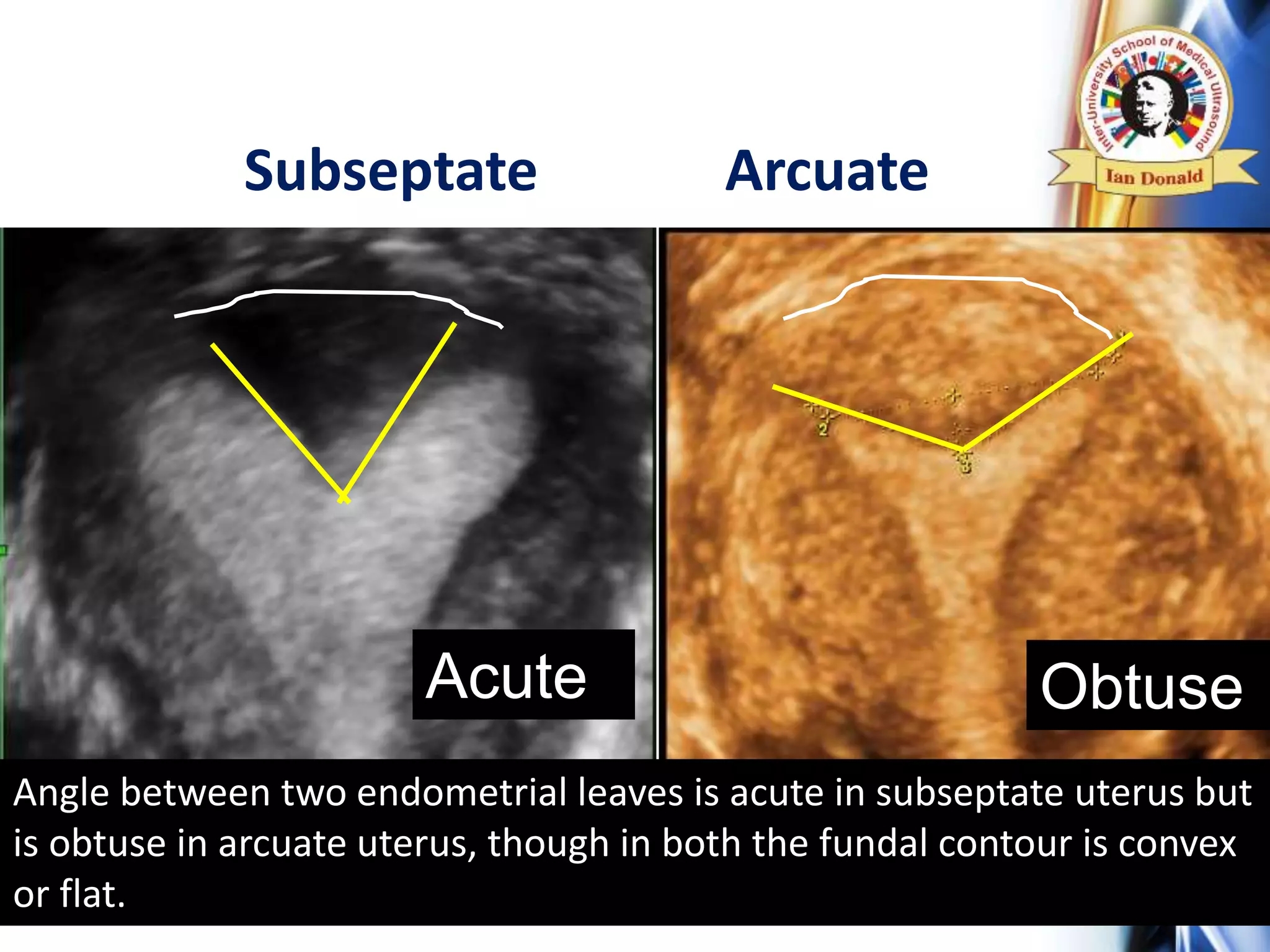 3D-4D ULTRASOUND IN UTERINE SEPTUM EVALUATION | PPTX