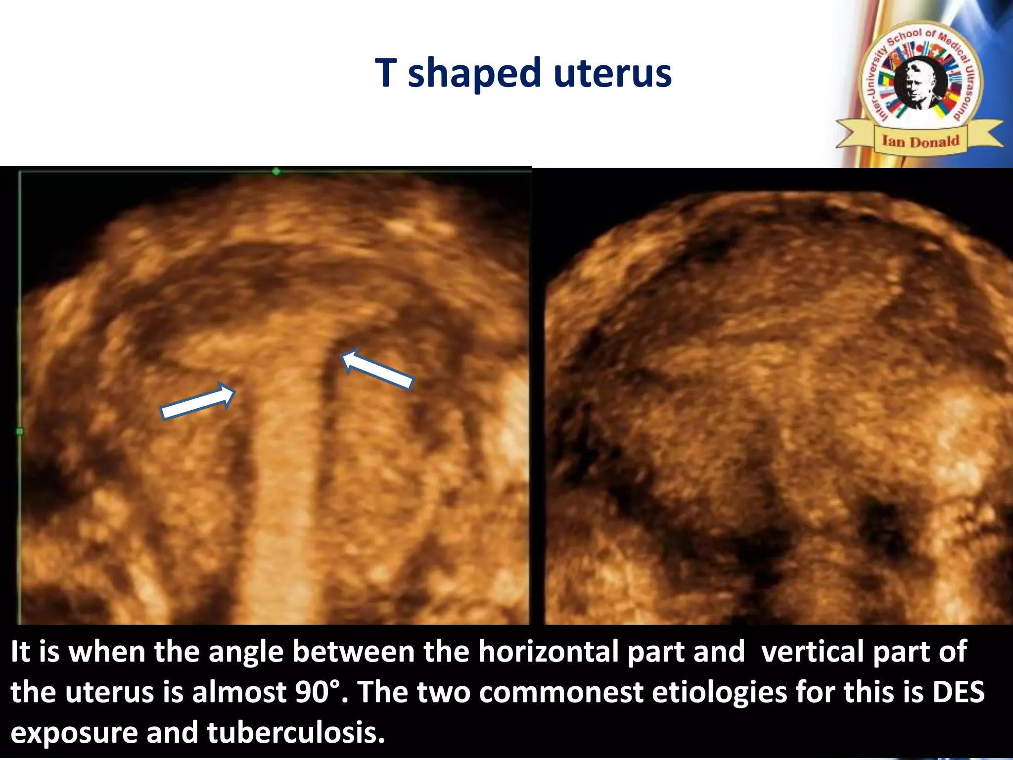 3D-4D ULTRASOUND IN UTERINE SEPTUM EVALUATION | PPTX
